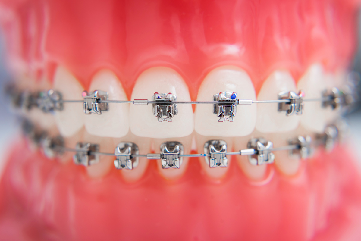 Orthodontics in Anaheim Fullerton Orthodontist Orange Orthodontics Berger Orthodontics